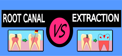 Root Canal vs Extraction, Pros and Cons | Tijuana Dental Studio Tijuana ...