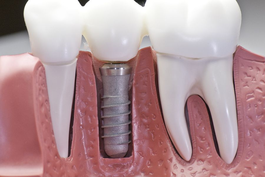 Dealing With Dental Bone Loss: Dental Implants and Bone Regeneration ...