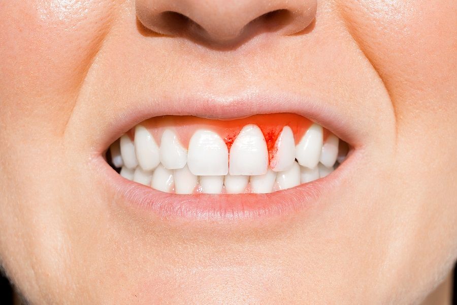 Treatments Available for Bleeding Gums | Primary Dental Clinic Midland, TX
