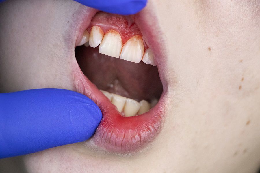SIX REASONS WHY YOU SHOULD SEE A PERIODONTIST TO EXAMINE YOUR GUMS ... SIX REASONS WHY YOU SHOULD SEE A PERIODONTIST TO EXAMINE YOUR GUMS ...