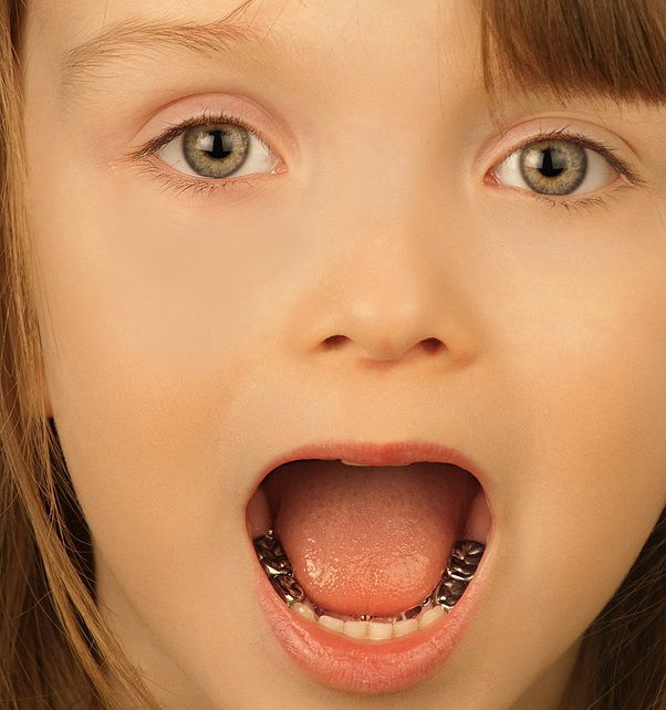 Main steps of the pediatric dental crown procedure | Modesto Kidz ...