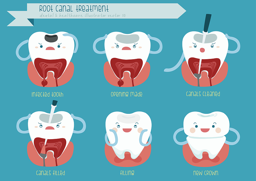 Understanding Root Canal Treatment: A Path to Saving Your Smile ...