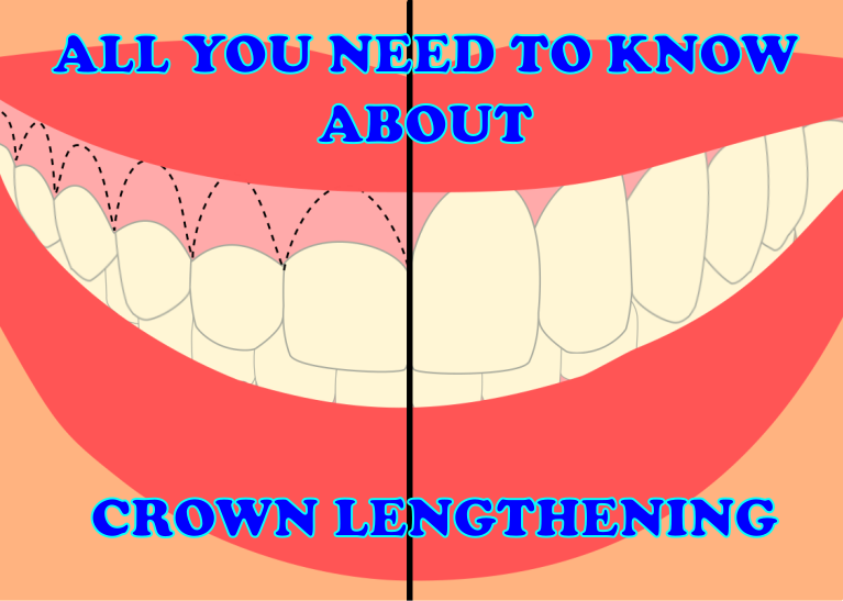 All you need to know about Crown Lengthening | Tijuana Dental Studio ...