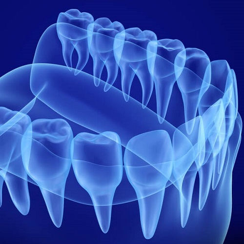 What are the Benefits of Dental Veneers? | West Valley Natural ...