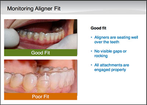 Top Tips for Successful Aligner Treatment | Lawless Orthodontics ...