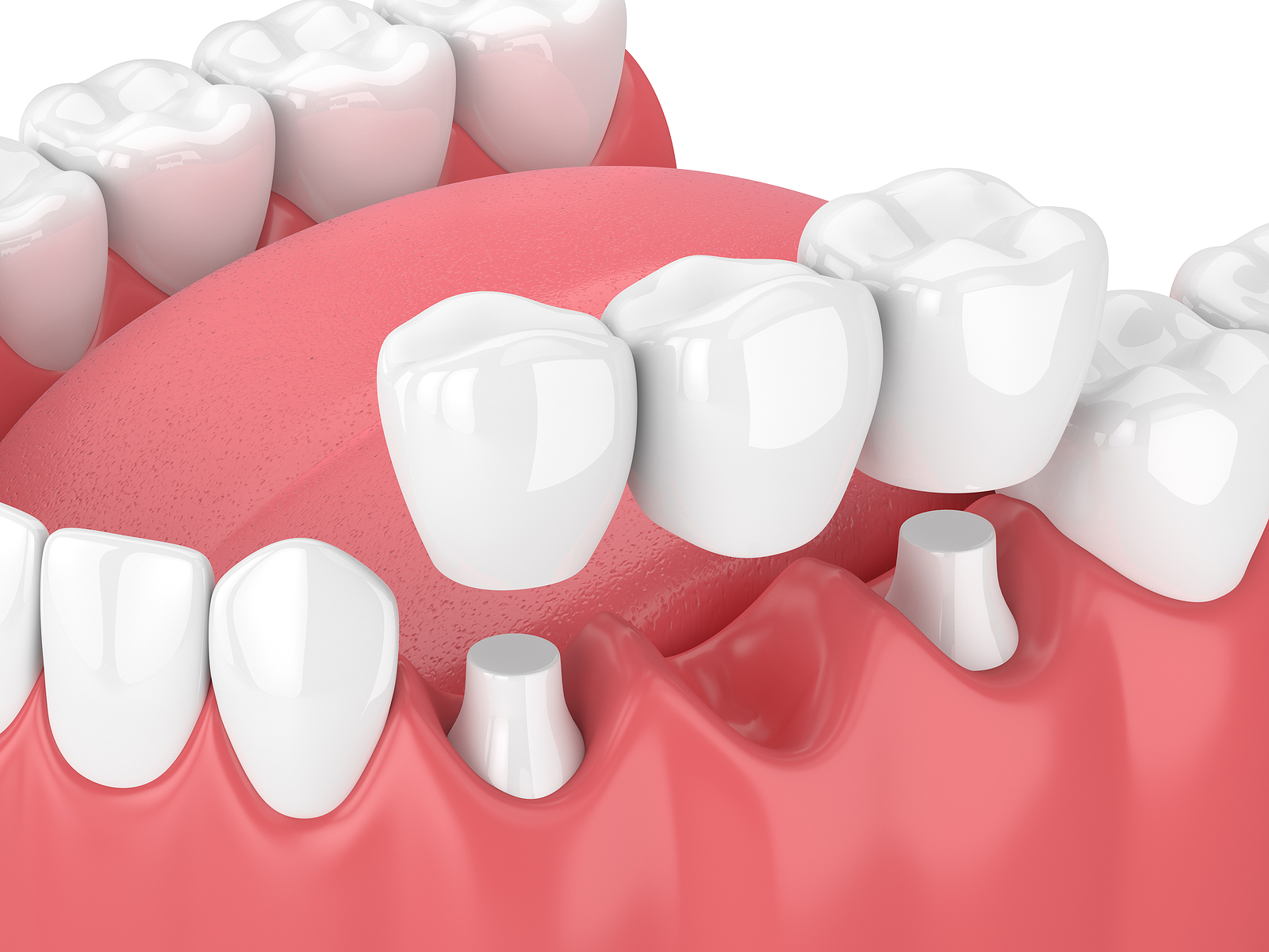 Dental Bridges in Midland, TX: A Comprehensive Guide to Restoring Your ...