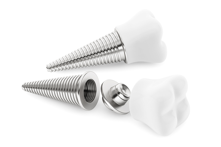 The Ultimate Guide to Dental Implants: Restoring Your Smile with ...