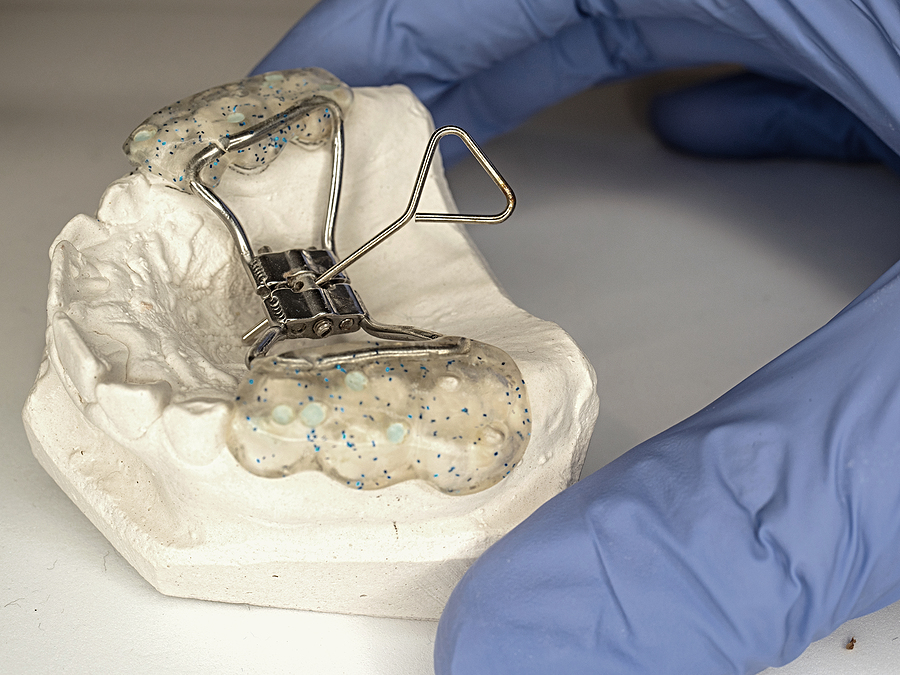 Understanding Palatal Expanders: A Key Solution for Orthodontic Health ...