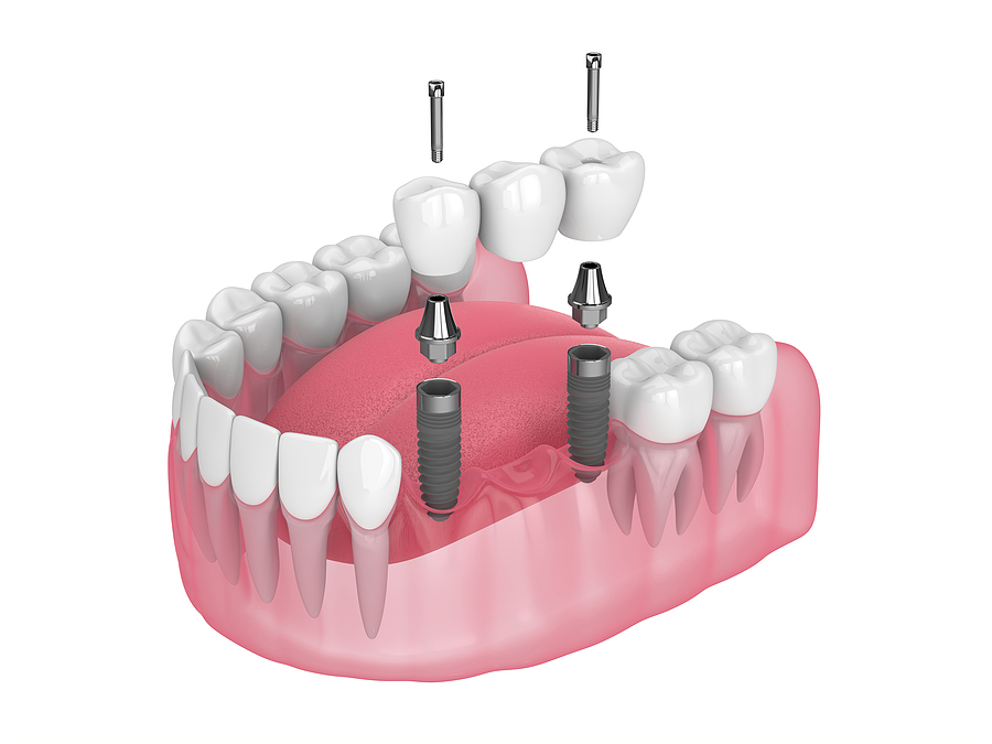 Dental Bridges Explained | Everything You Need to Know