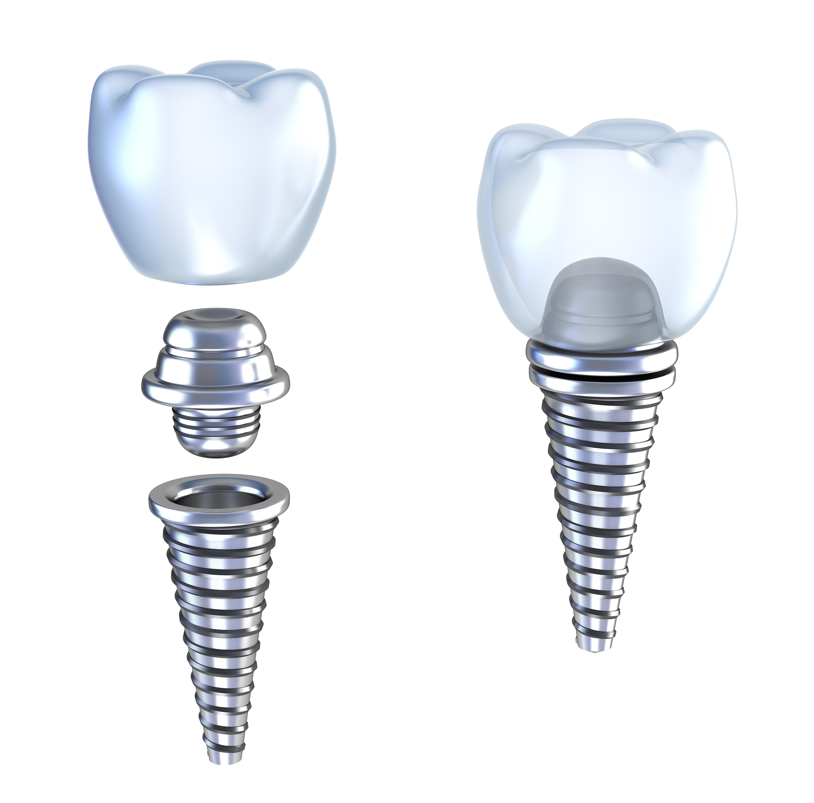 Learn How Implant Restoration Works | Advanced Dentistry Of Walnut ...