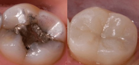 Safe Amalgam Removal in Seattle, WA | Seattle Dental Care | SMART