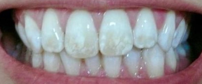 Fluoride Affects Overall Health | Seattle Dental Care Seattle, WA