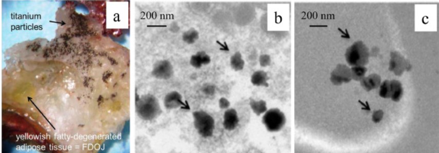 6 Warning Signs for Titanium Implant Allergy | Seattle Dental Care ...