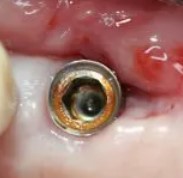 6 Warning Signs for Titanium Implant Allergy | Seattle Dental Care