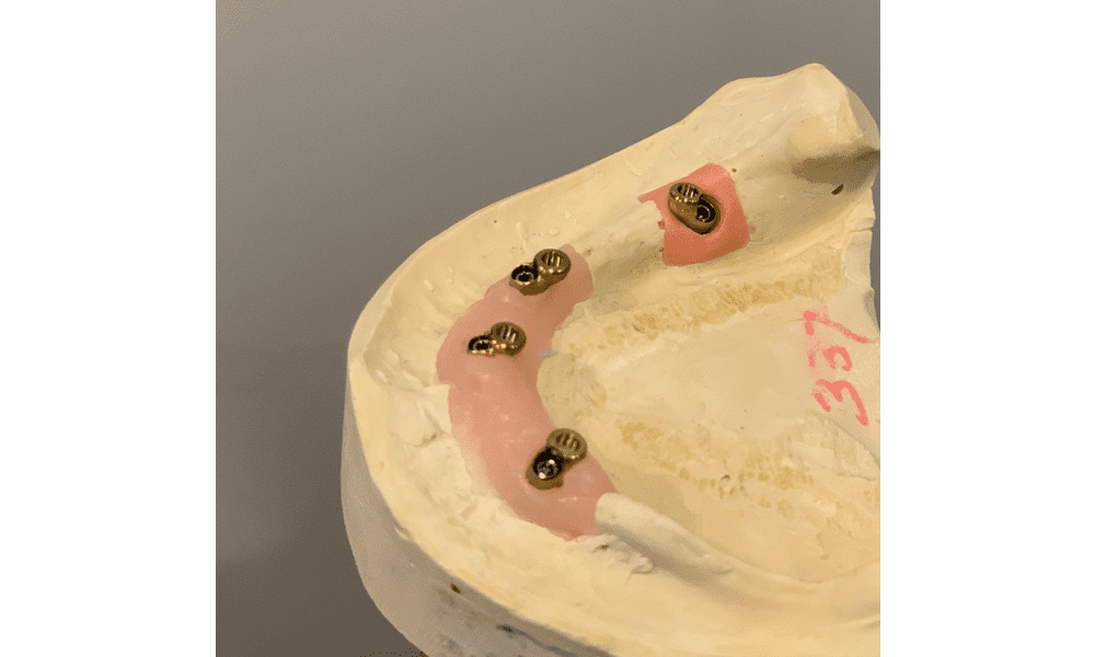 Customized locator abutment improve the precision of snap-on dentures ...