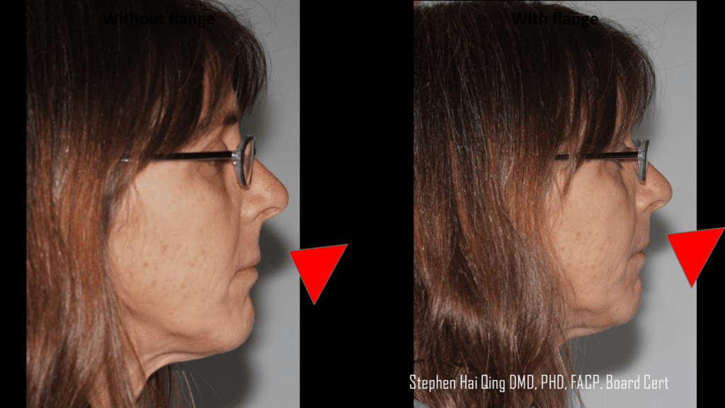 Implant-supported crown and bridge prosthesis—Pros and Cons, and ...