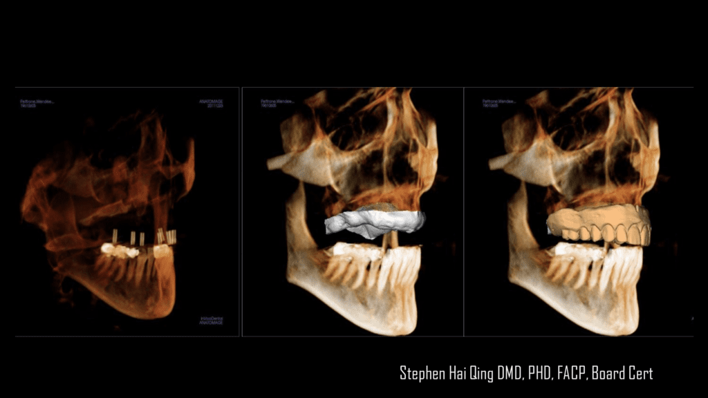 Implant-supported crown and bridge prosthesis—Pros and Cons, and ...