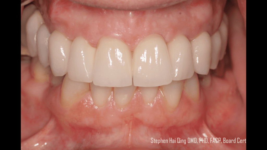 Implant-supported crown and bridge prosthesis—Pros and Cons, and ...