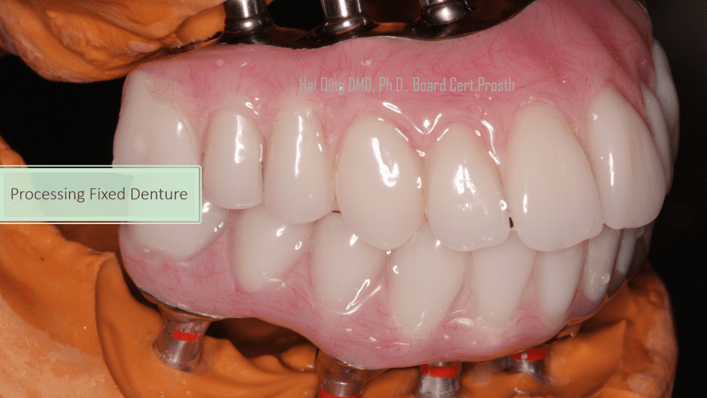 Implant Supported Fixed Denture ( other names as All-on-four or hybrid ...