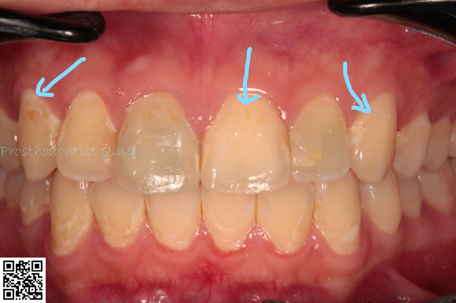 Aesthetic Journey of A Student With White Spot Lesions | Bucks Dental ...