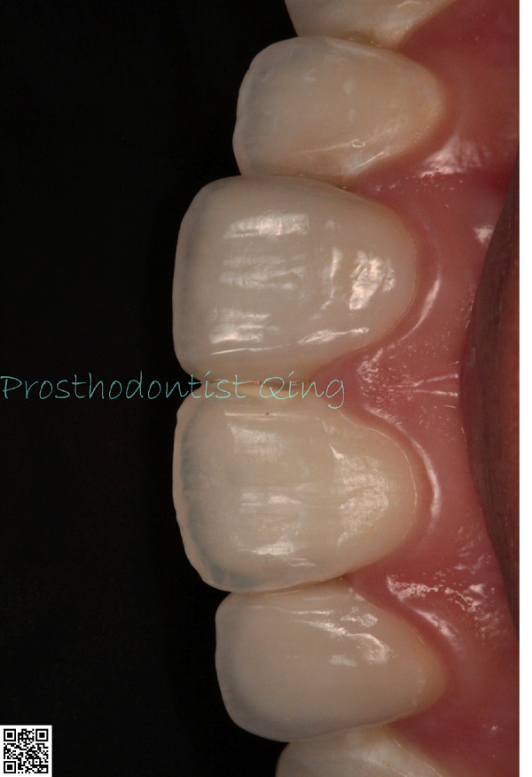 Aesthetic Journey of A Student With White Spot Lesions | Bucks Dental ...