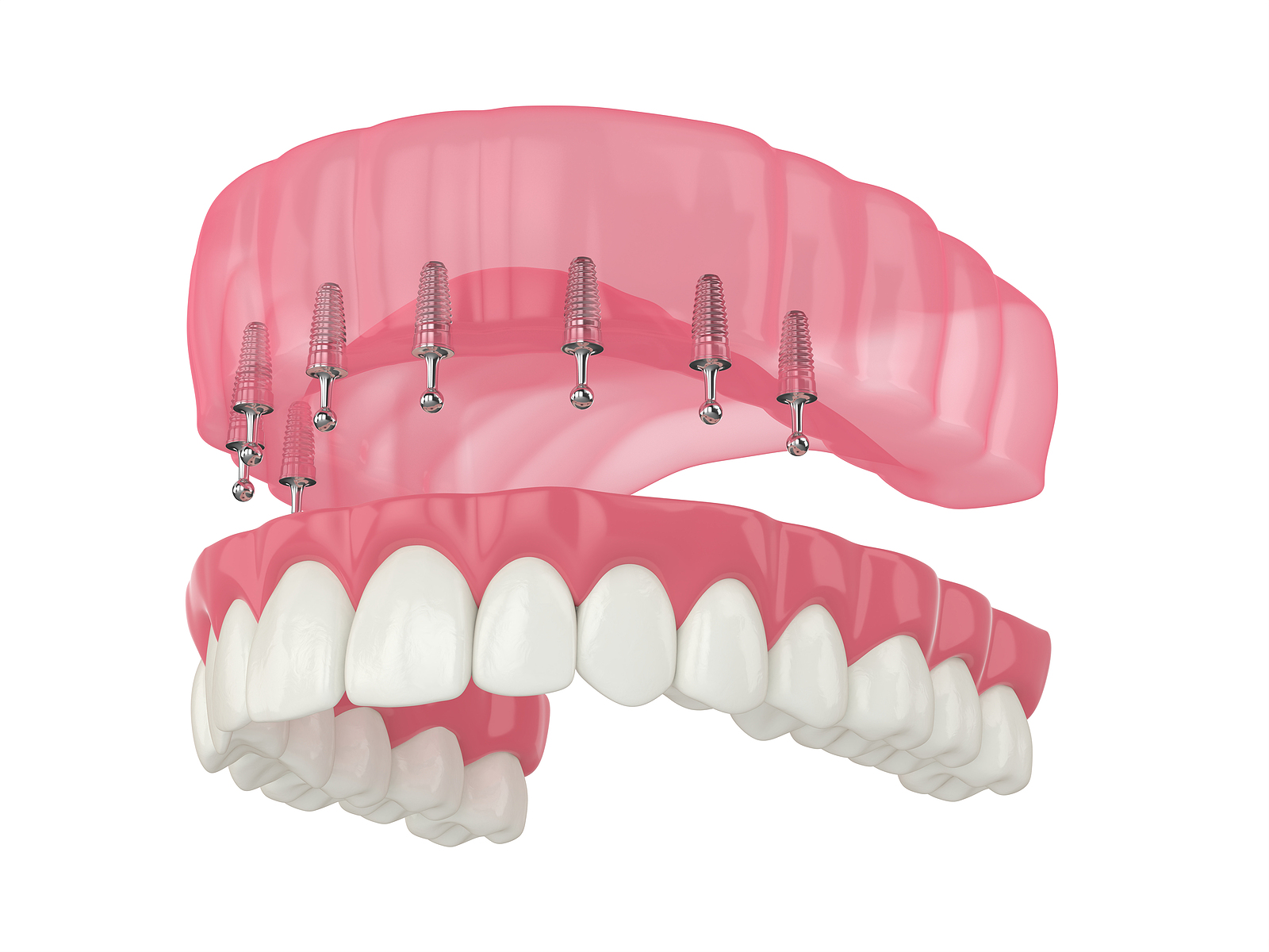 Denture Placement in Alexandria, VA & Manassas, VA