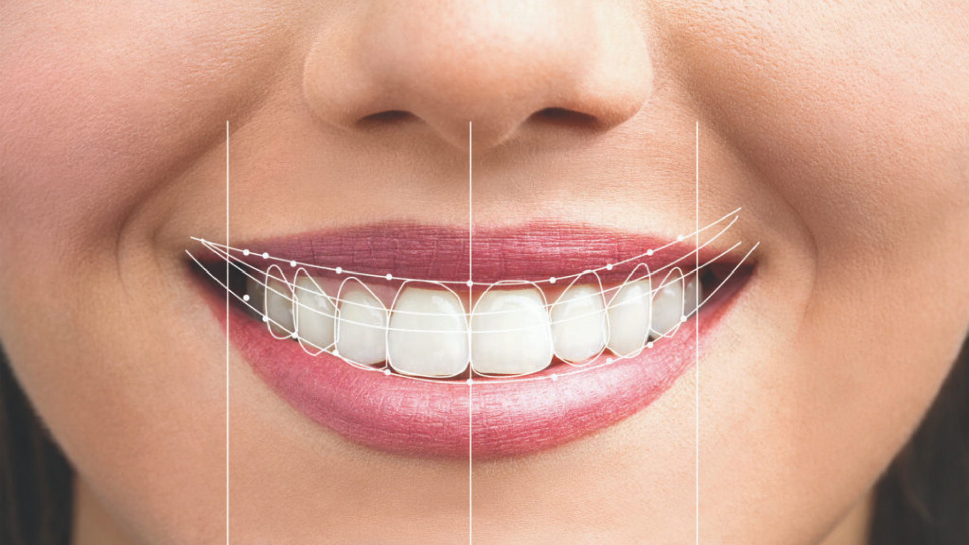 Digital Smile Design in Los Angeles CA