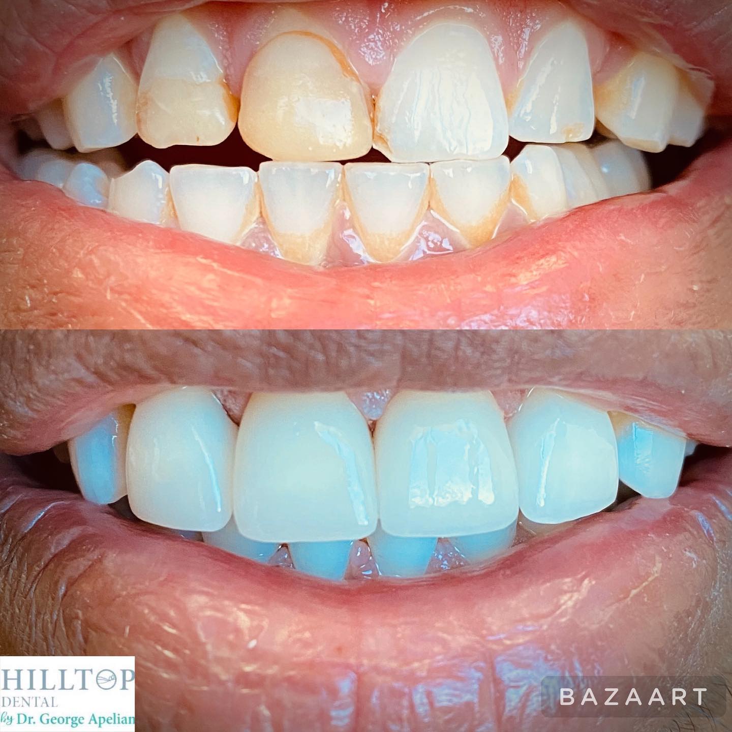 Smile Gallery | Hilltop Dental by Dr. George Apelian Agoura Hills, CA