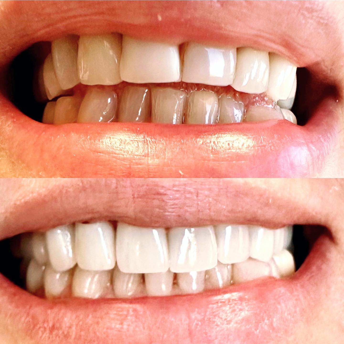 Smile Gallery | Hilltop Dental by Dr. George Apelian Agoura Hills, CA