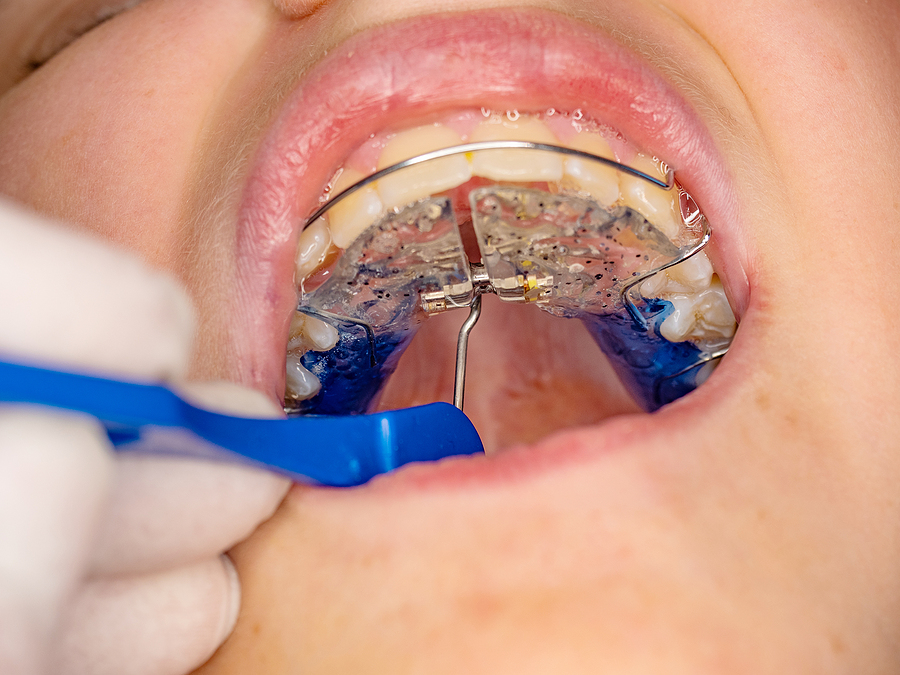 A Comprehensive Guide to Dental Expanders in Oklahoma City & Kingfisher ...
