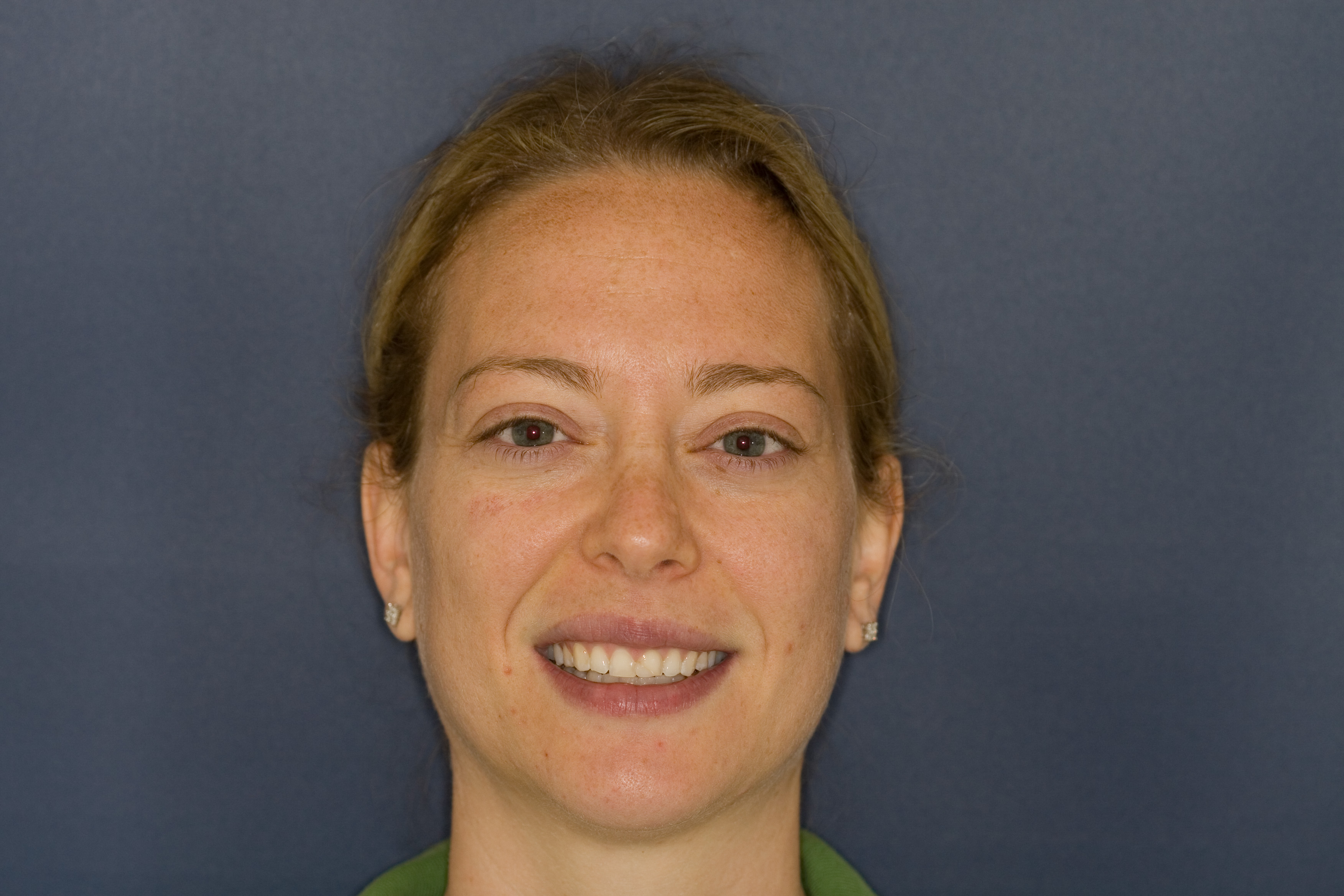 Smile Gallery | Burba Dental Partners Salem, MA