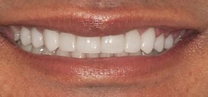 Smile Gallery | Burba Dental Partners Salem, MA