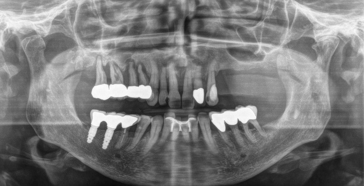 Panorex | MountainView Dental Hurricane