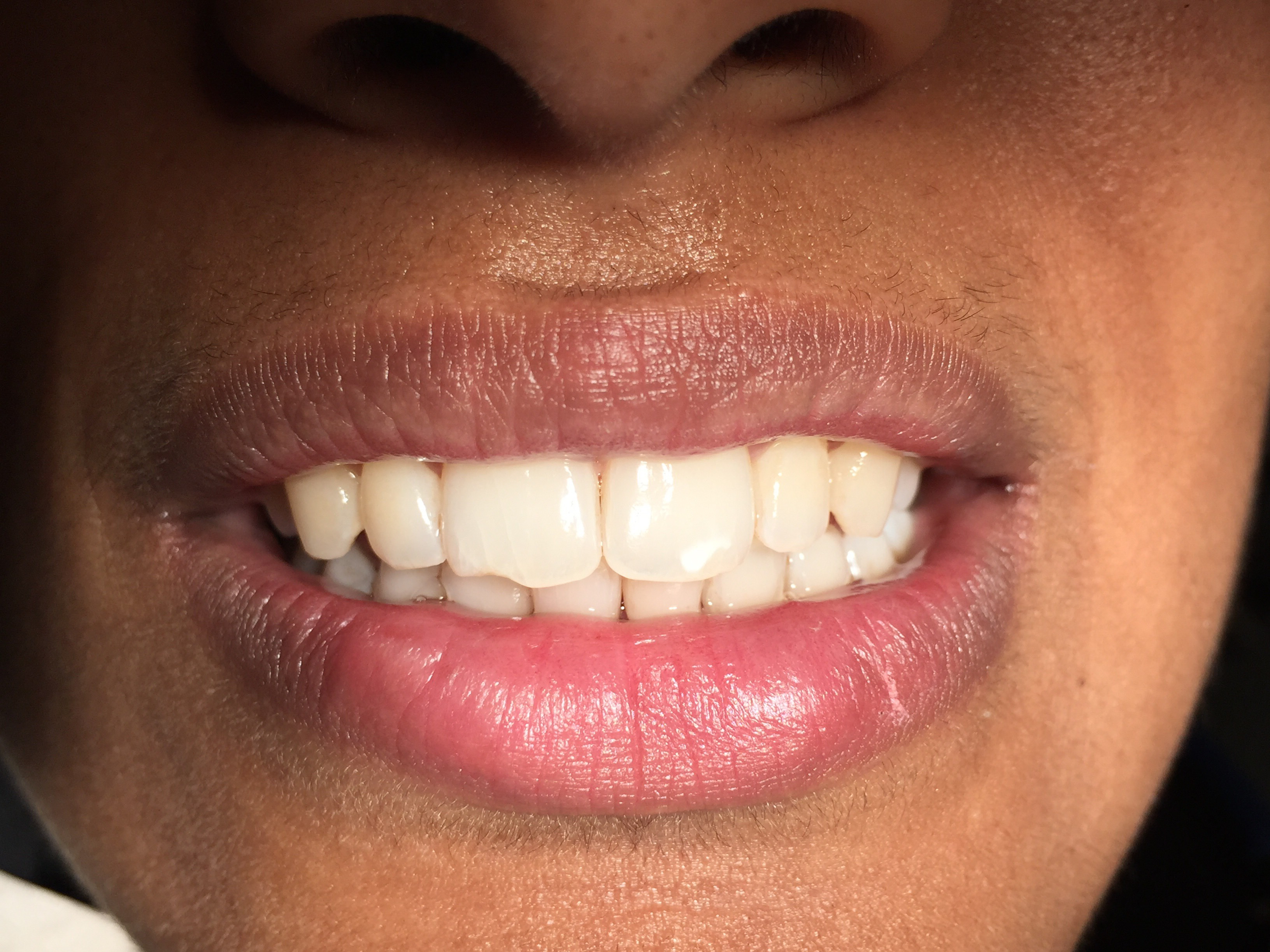 Smile Gallery | Swati Agarwal DDS, San Francisco CA