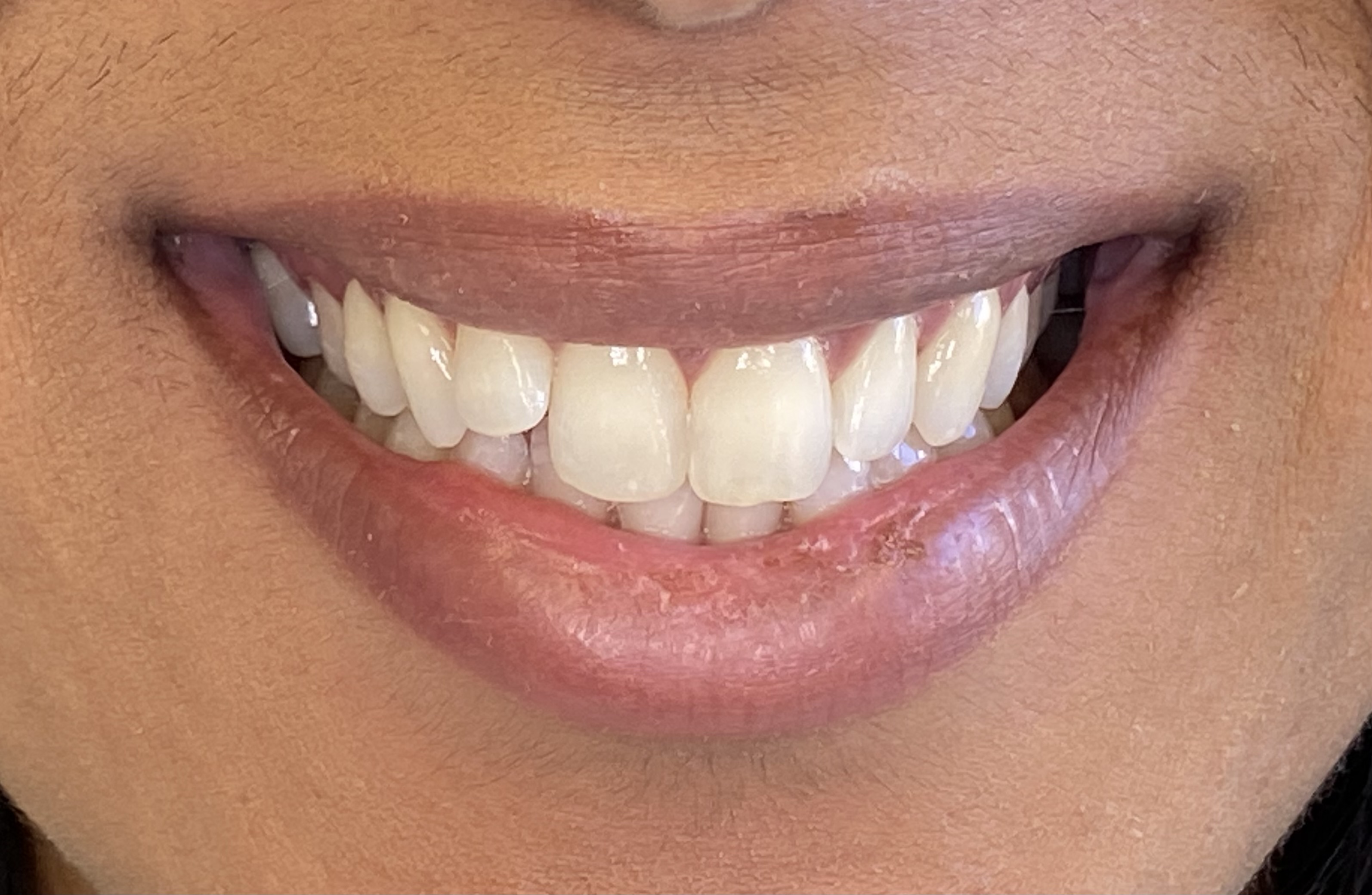 Smile Gallery | Swati Agarwal DDS, San Francisco CA