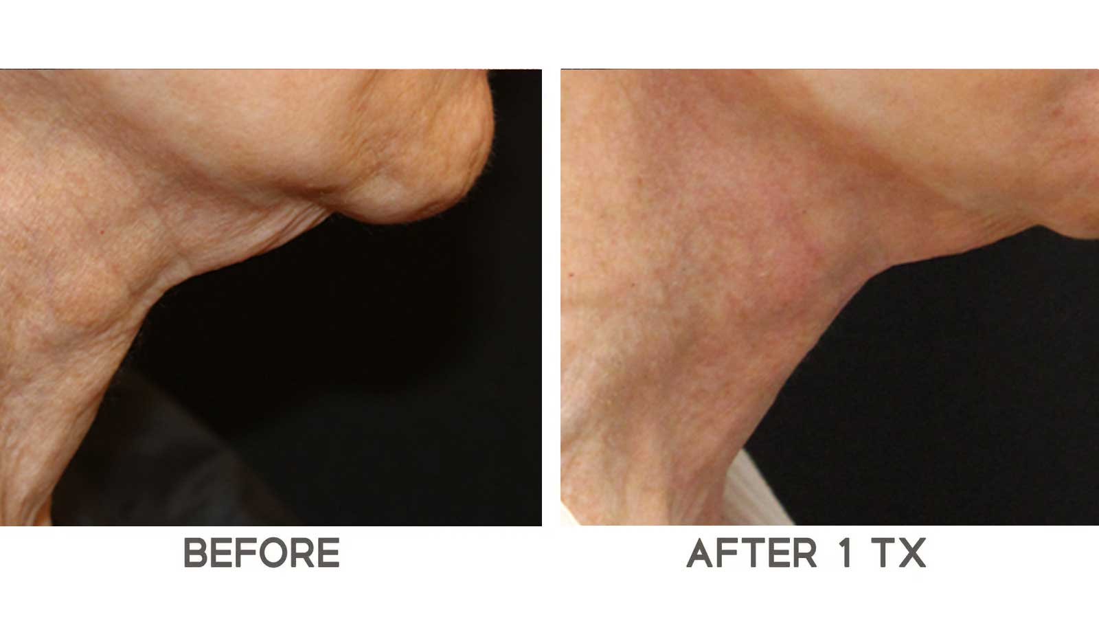 Opus Plasma Skin Resurfacing in Santa Barbara, CA
