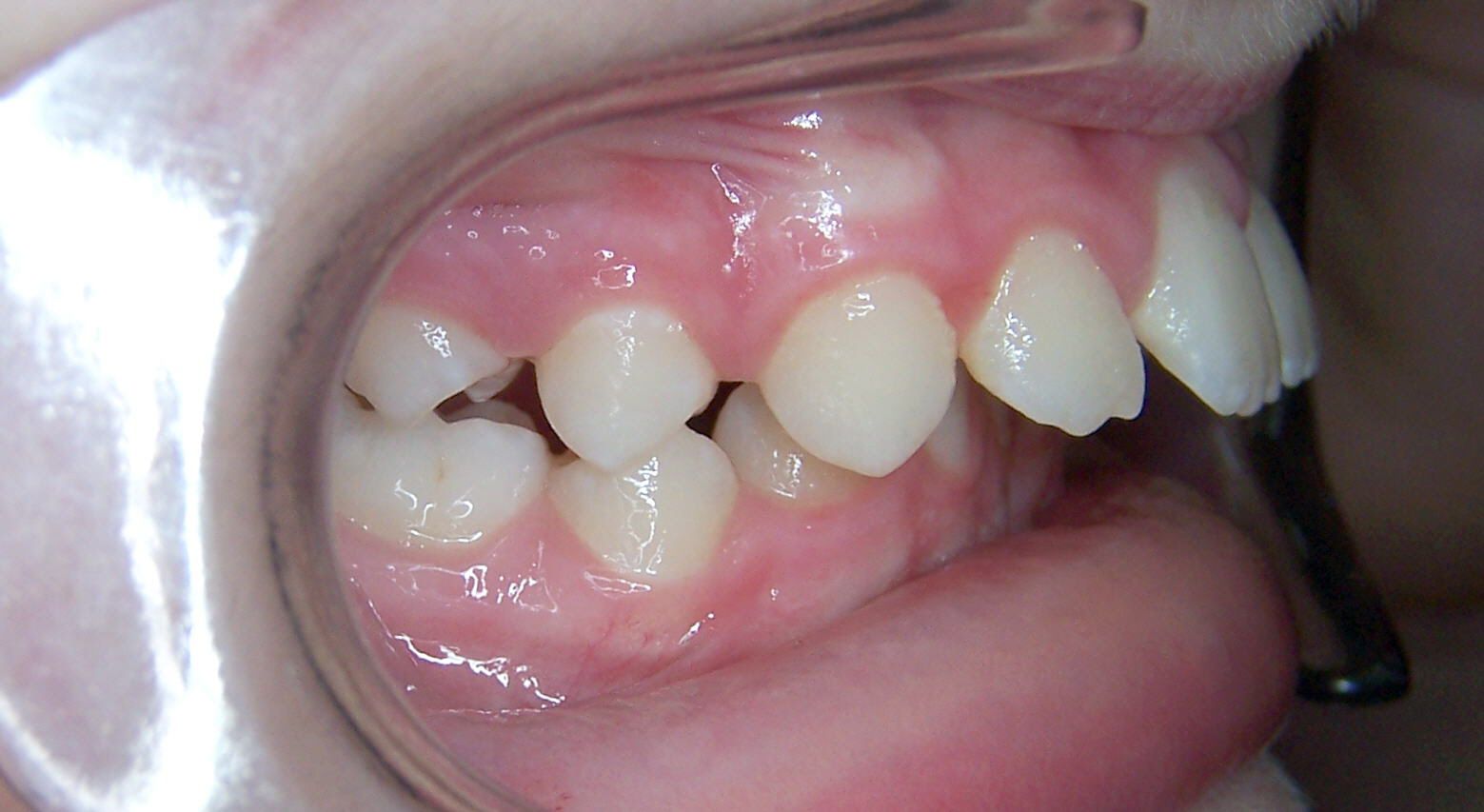 Before & After | Williams & Hamman Orthodontics