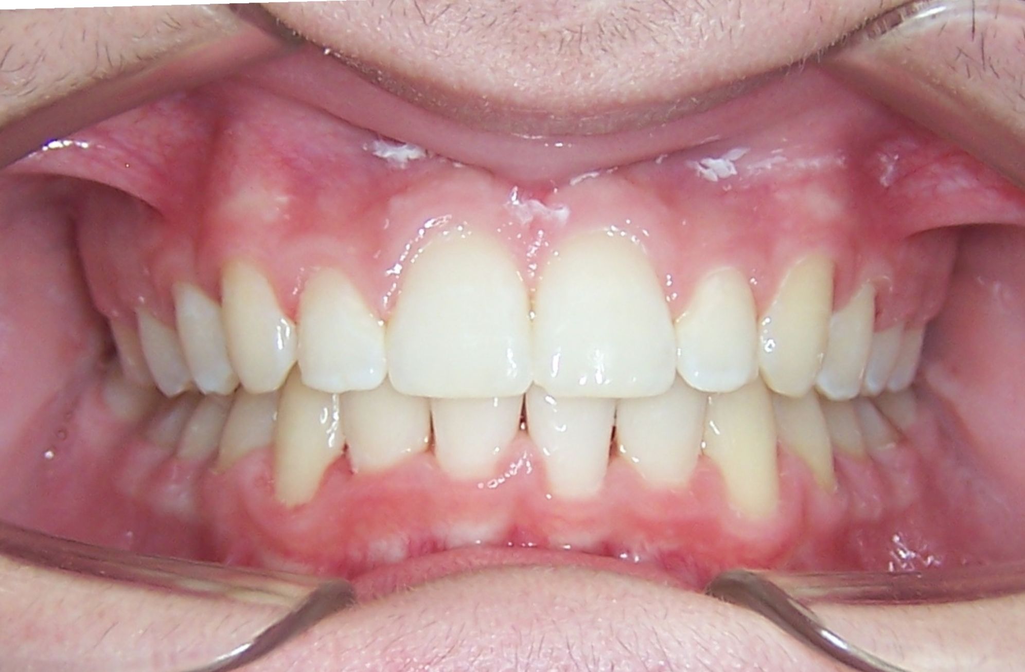 Before & After | Williams & Hamman Orthodontics