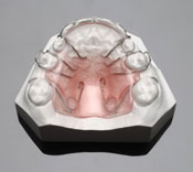 Orthodontic Appliances | Sublime Smiles Orthodontics Rockville, MD ...