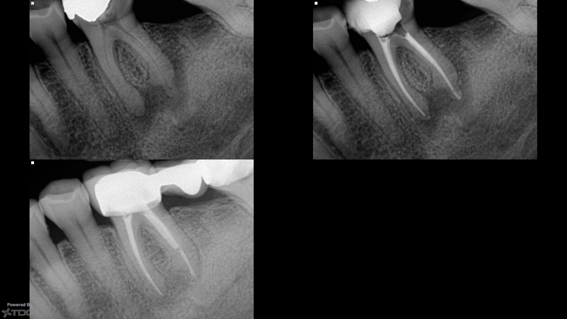 What is Endodontics? | Big Apple Endodontics New York, NY | 10022