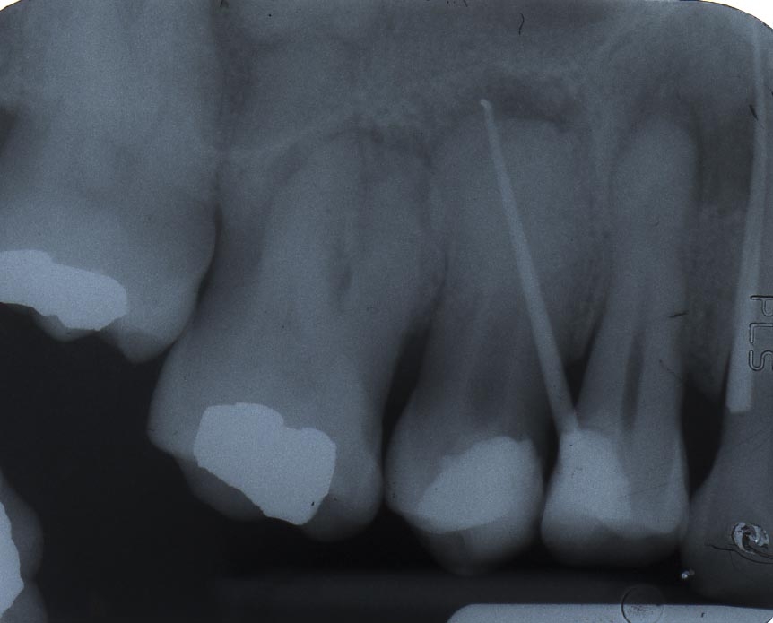 What is Endodontics? | Big Apple Endodontics New York, NY | 10022