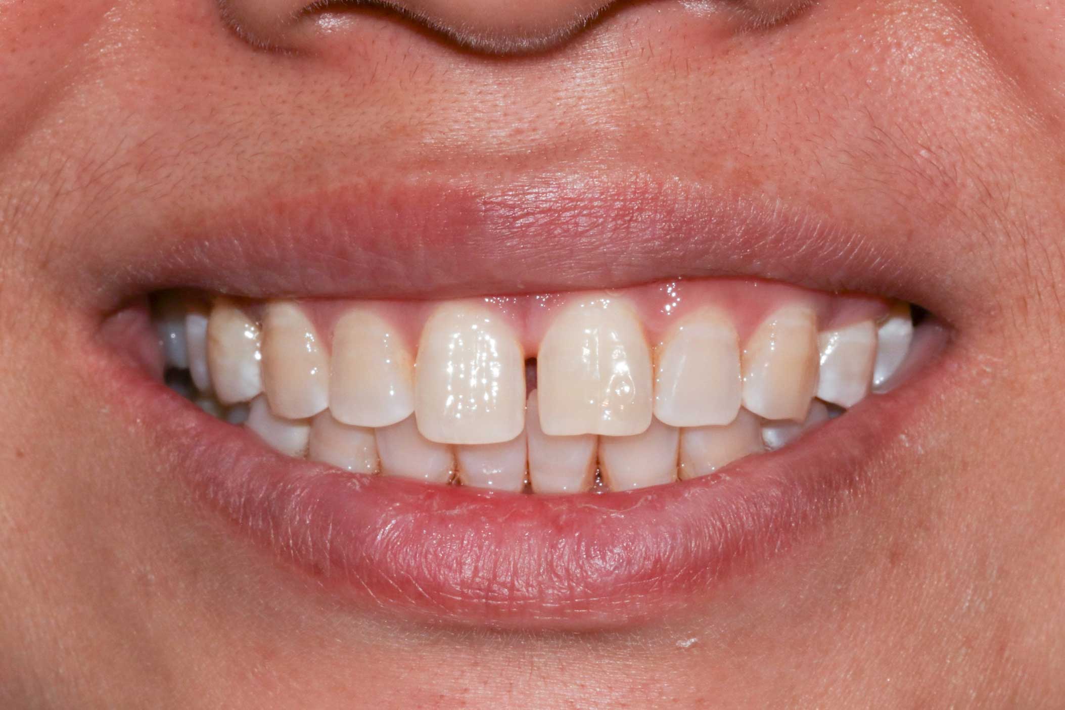 Smile Gallery | iSmile Dental Group LLC Columbus