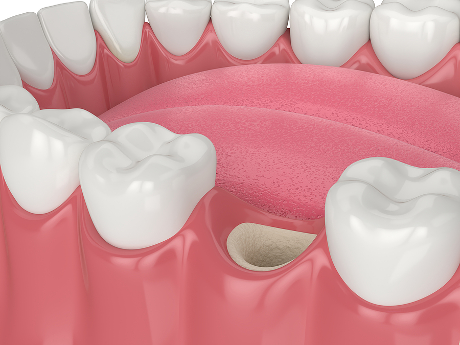 Preserving Your Smile: The Importance of Socket Preservation in Eagle ...