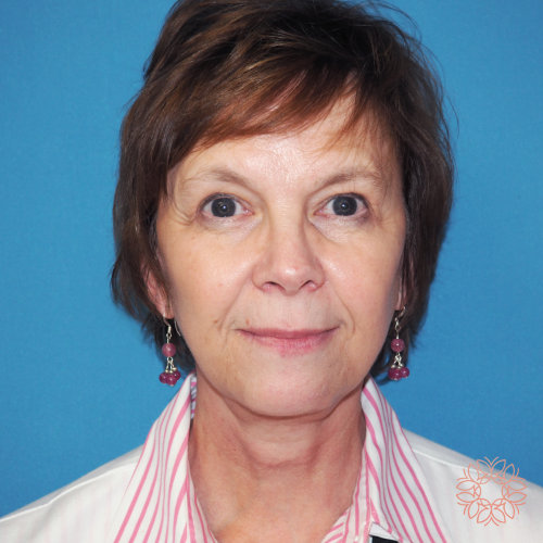 Facelifte | Joyce Aycock MD Denver, CO