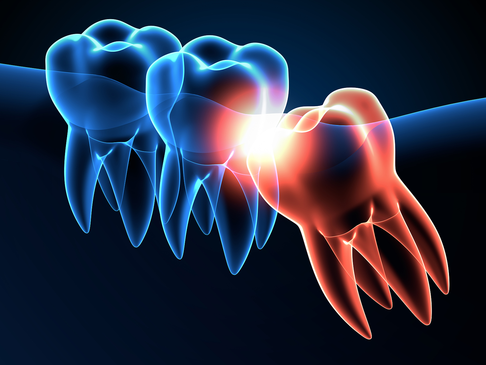Wisdom Teeth Extraction in Santa Maria & Arroyo Grande, CA
