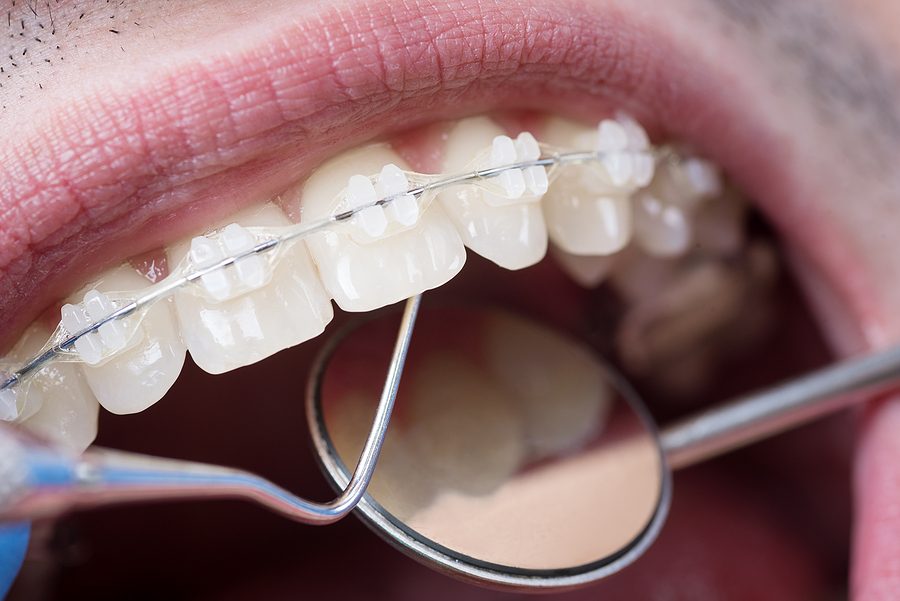 A Comprehensive Guide to the Different Types of Braces for a Perfect ...