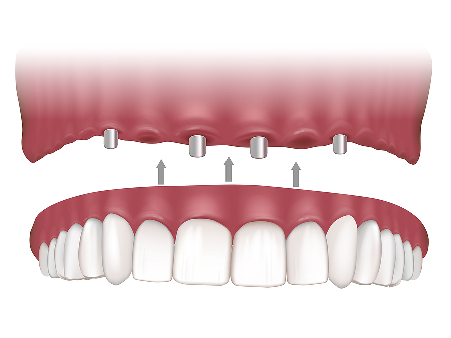 Transform Your Smile with All-on-4 Implants in Elk Grove, CA | Smile ...