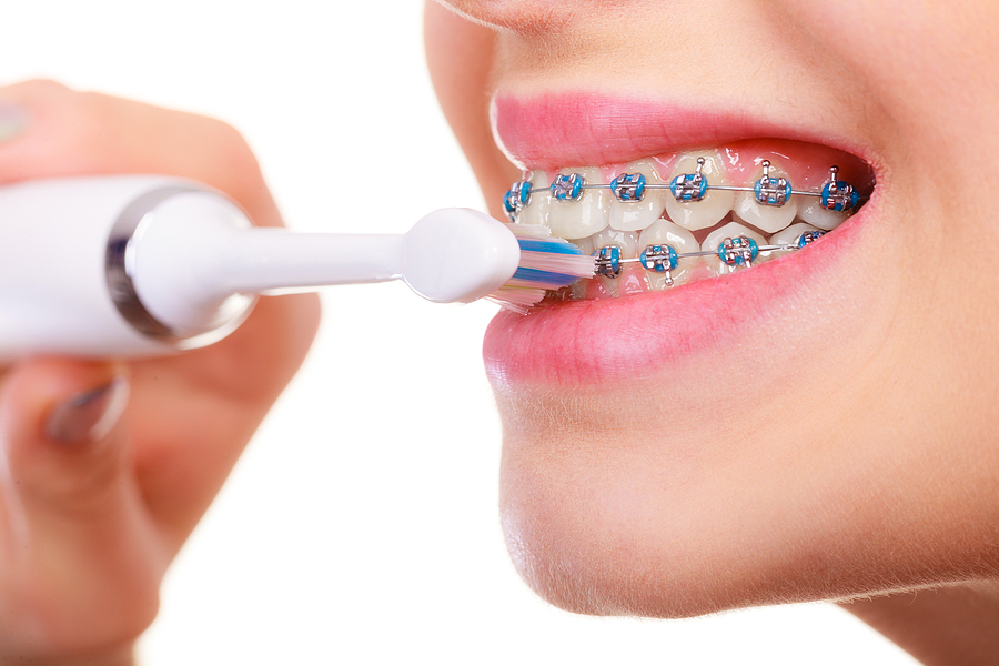 The Science Behind Tooth Movement: How Braces Really Work | Dental ...
