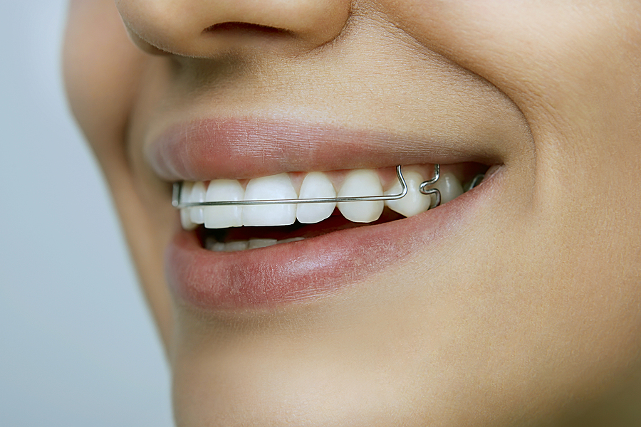 Everything You Need to Know About Retainers in Brooklyn and New York ...