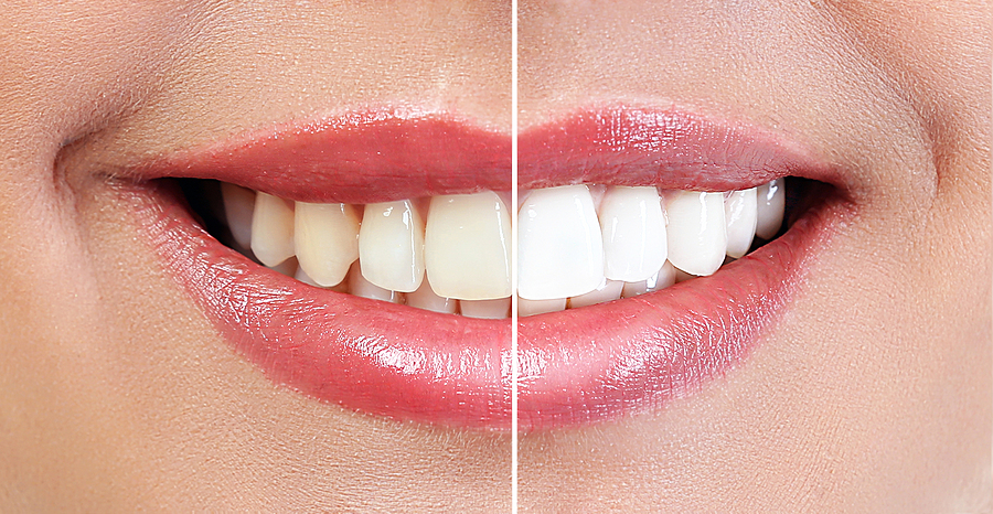 Brighten Your Smile: The Ultimate Guide to Teeth Whitening in Brooklyn ...